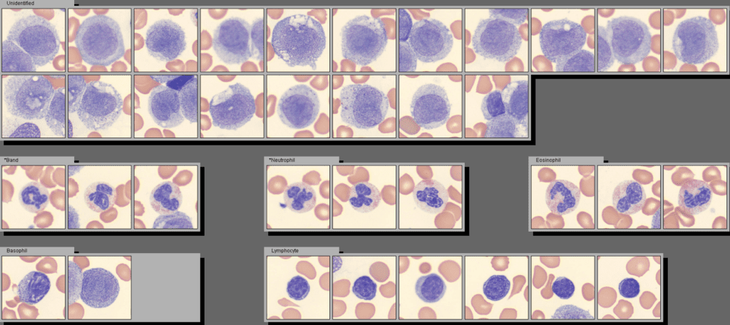 Acute Monocytic Leukemia (AML-M5) - Classical hematology