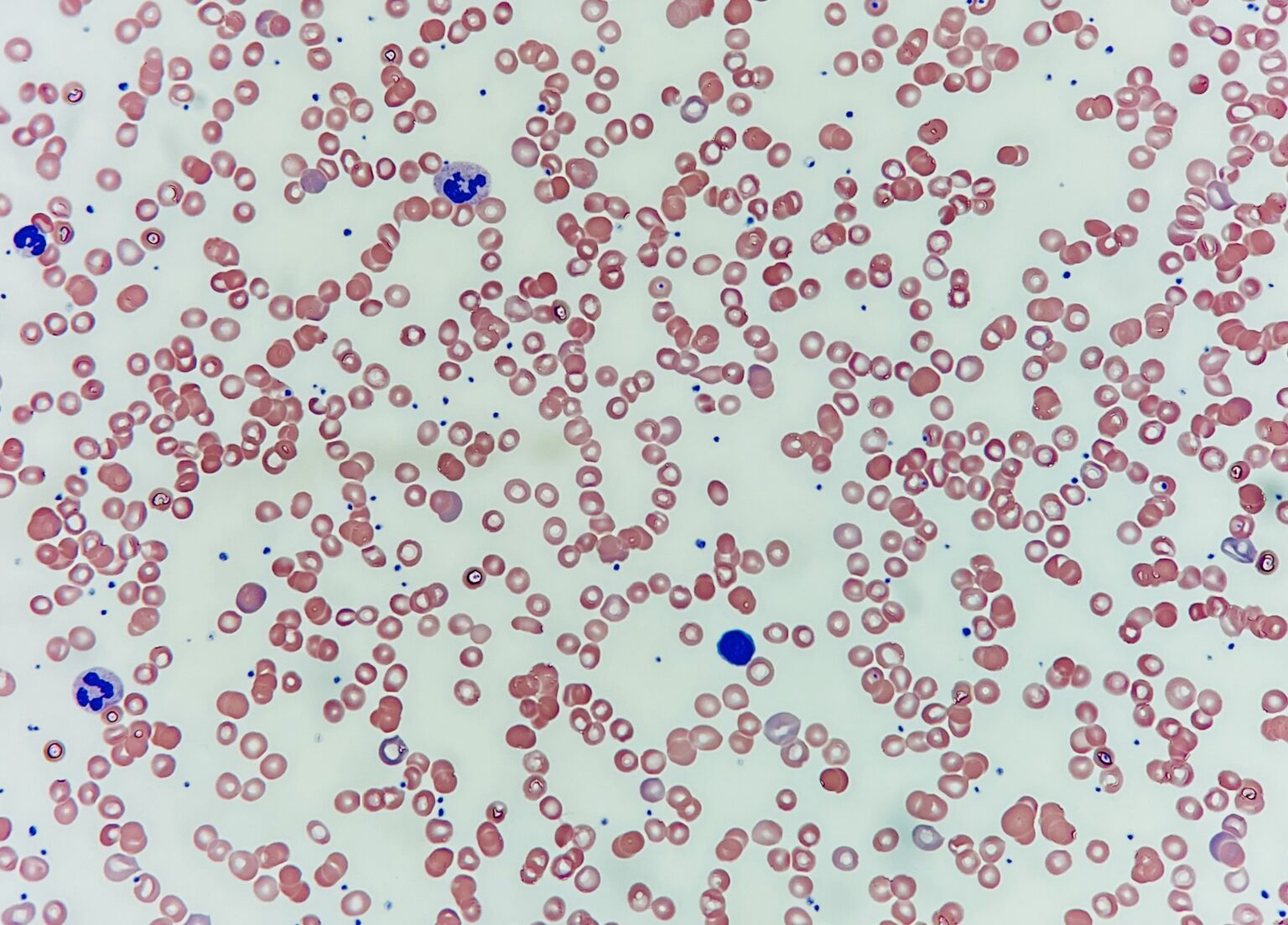 Evaluation of the Peripheral Blood Smear - Classical hematology