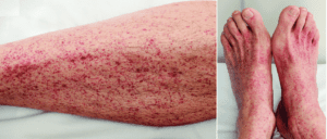 History and Physical Examination in Hematology - Classical hematology