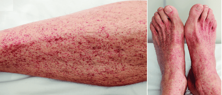 History and Physical Examination in Hematology - Classical hematology