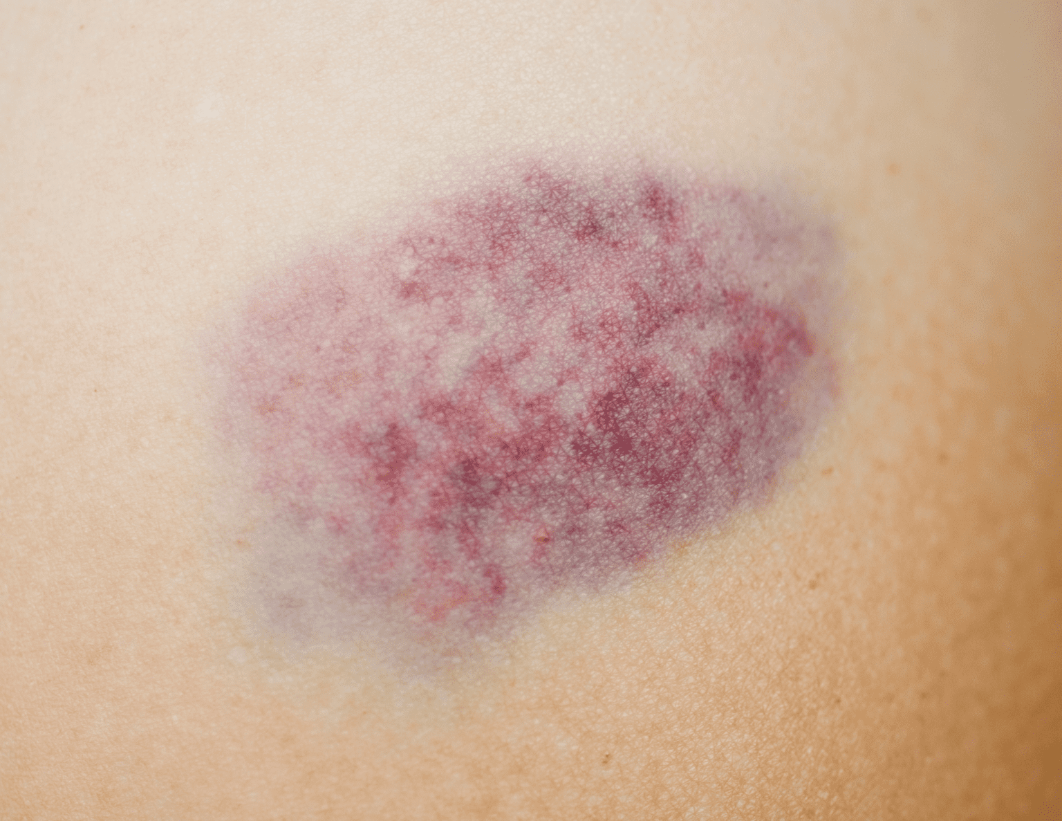 History and Physical Examination in Hematology - Classical hematology