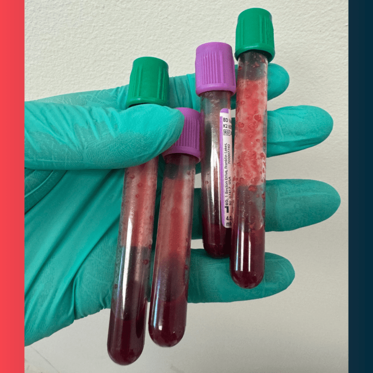 Bone Marrow Biopsy in Clinical Practice - Classical hematology