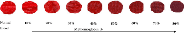 Methemoglobinemia - Classical hematology